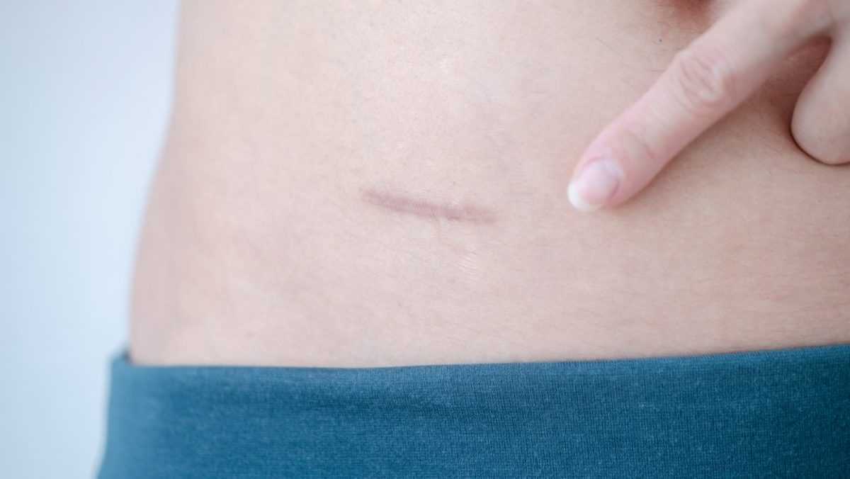 Hojenie rán bez jaziev: Českí vedci priniesli unikátny objav - Správy STVR